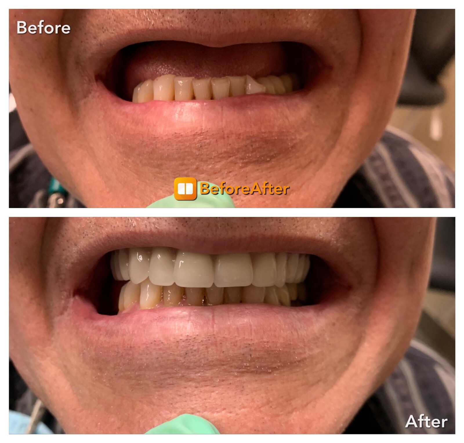 denture,partial,flipper,stayplate,nightguard,sportguard,retainer ...