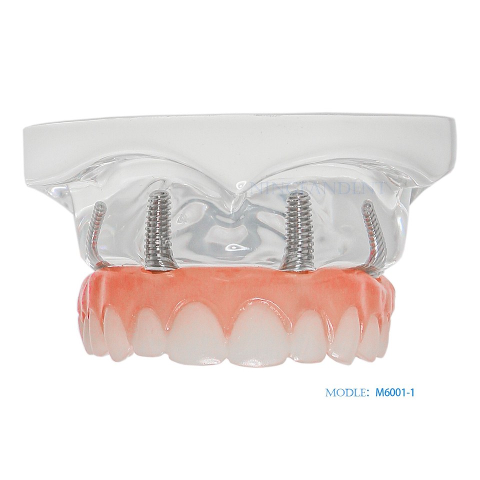 Dental Implant Modle,Lower Upper Jaw,RPD Dentures,Overdenture ...