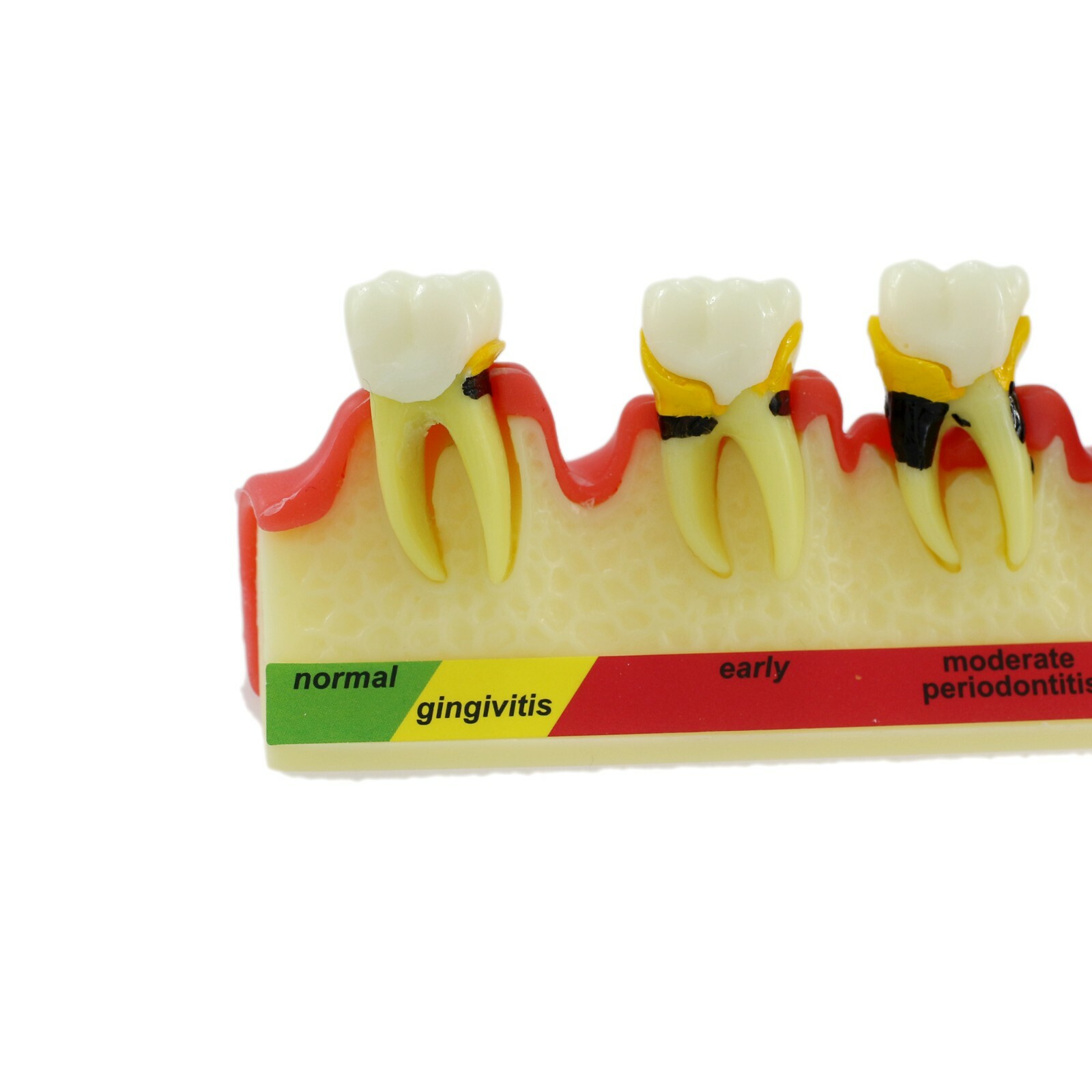 Dental Periodontics Typodont Teeth Model 5-Stage Perio Disease Assort ...
