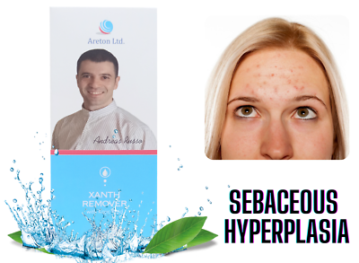 Can You Remove Sebaceous Hyperplasia At Home - Infoupdate.org