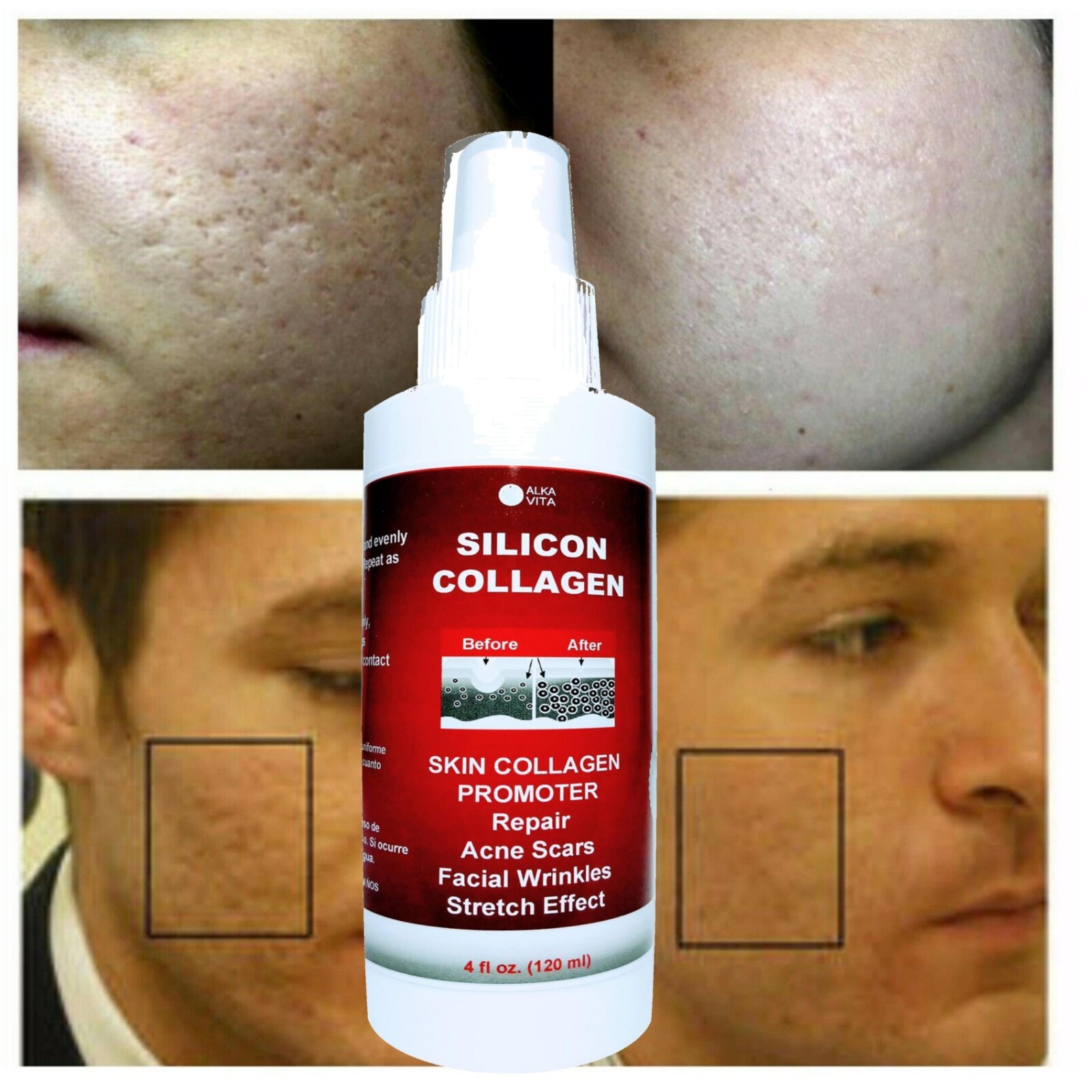 Alkavita Silicon & Collagen Topical Spray Acne Scars Wrinkles Blemishes ...