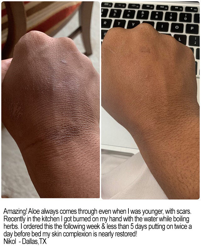 Emu Oil Scars Before And After Leven Rose Emu Oil 100% Pure Natural