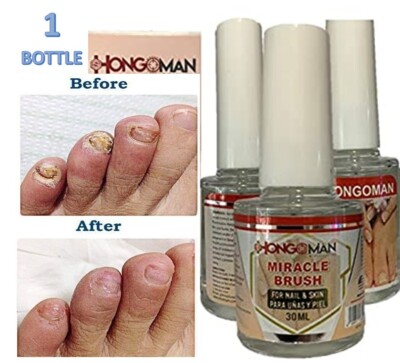 HoNGOSAN ORIUNDO natural life / Nail Fungus support toenail fungus ...