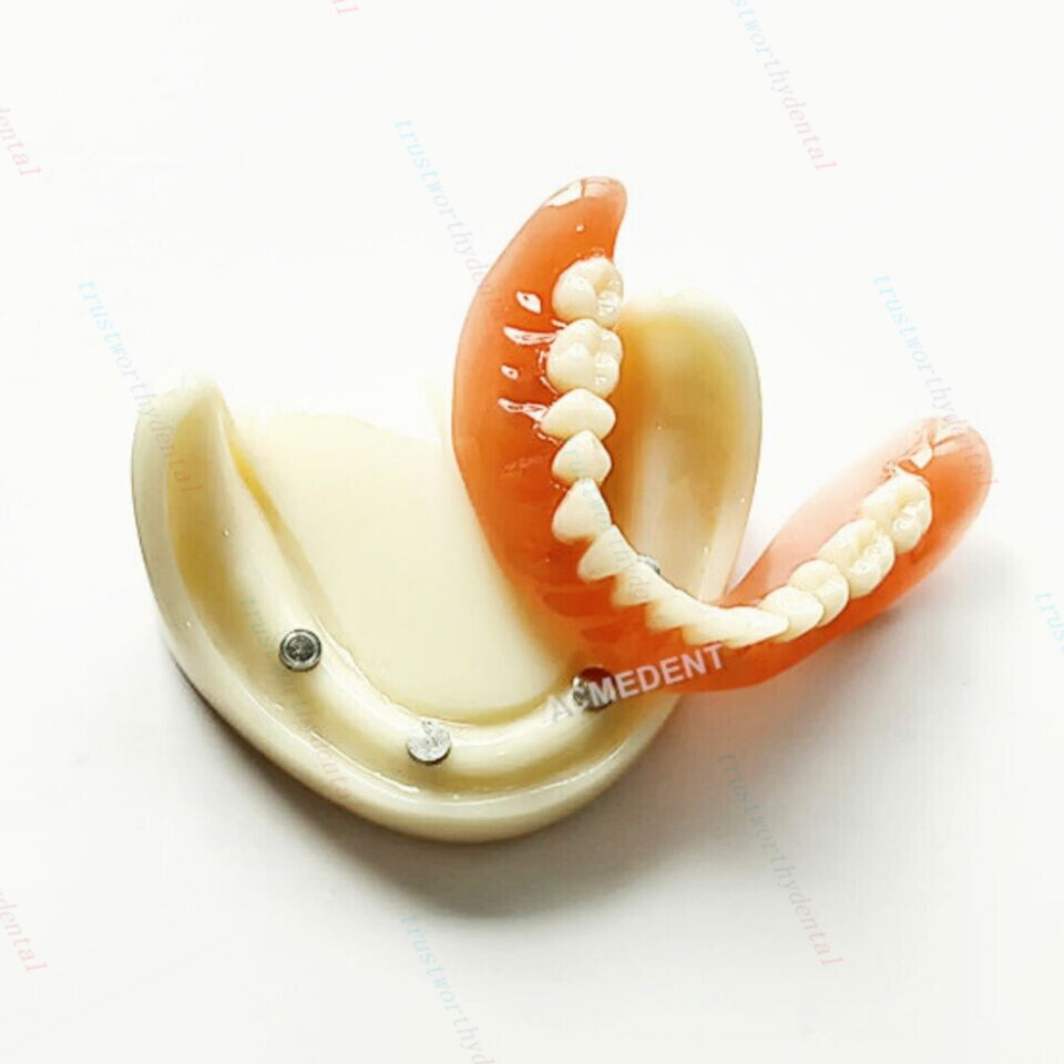 Dental Full Denture Model Overdenture Magnetic Attachment Mandibular ...