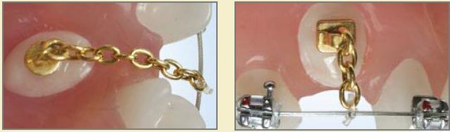 10pcs Dental Orthodontic Traction Chain Gold Plated Round Buttons with ...