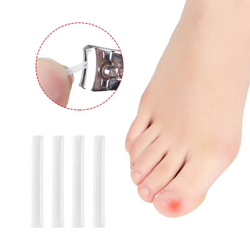 10x Toenail Straightening Clip Ingrown Toenail Correction Nail Patch ...