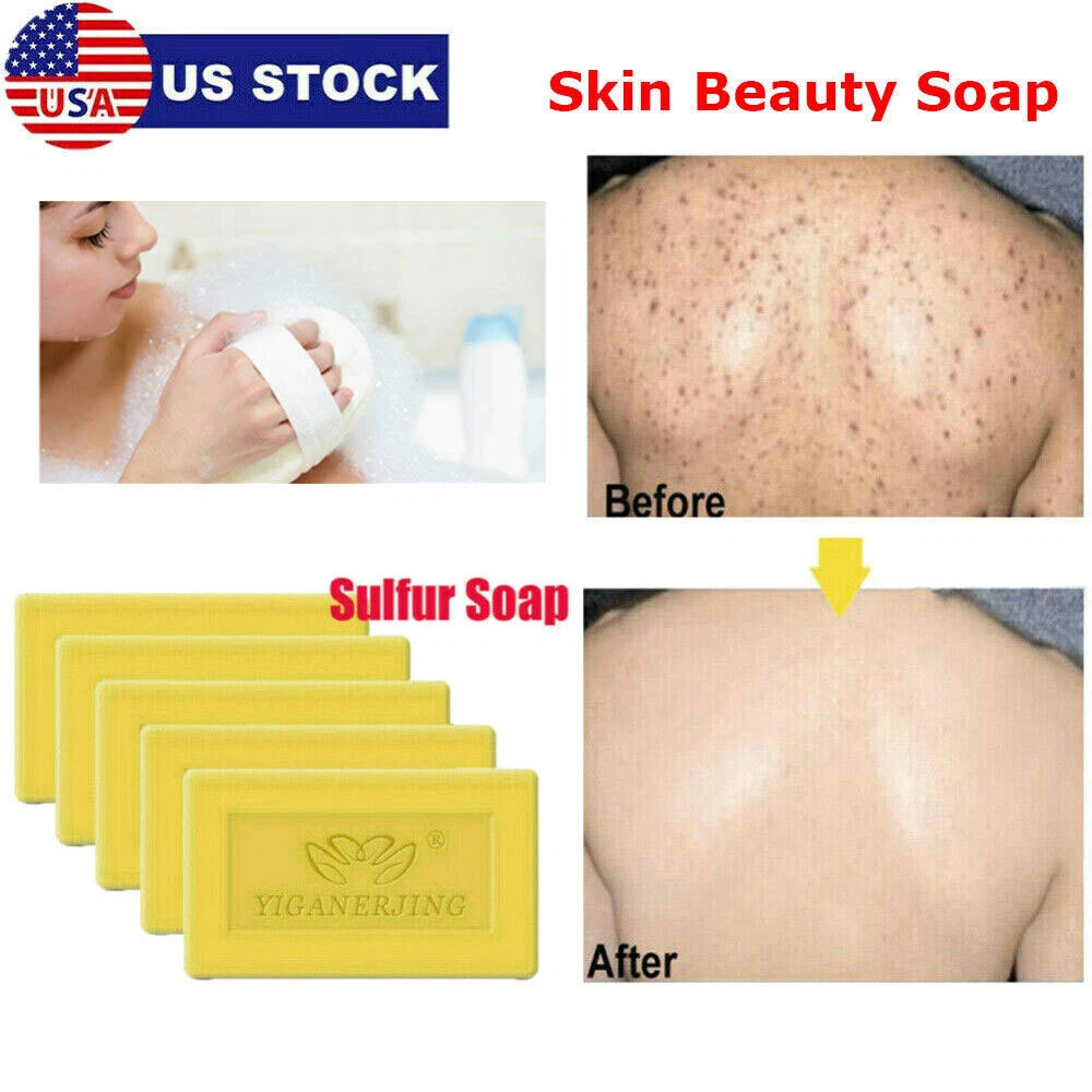 Sulfur Soap Before And After