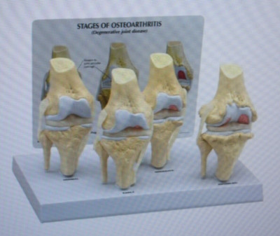 Model Anatomical Knee Osteoarthritic Knee 4 Stages Model 1100 Display ...