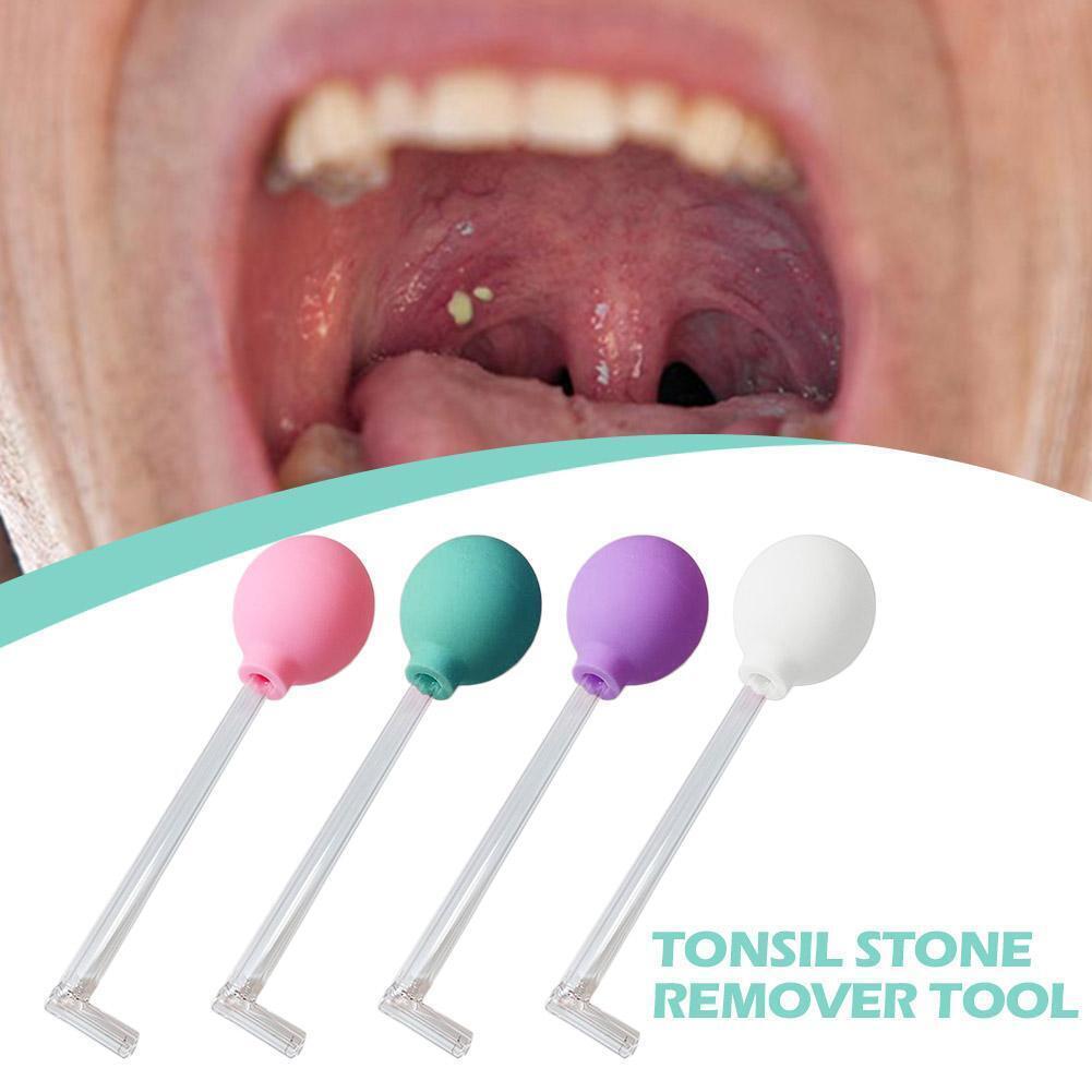 Tonsil Stones Removal
