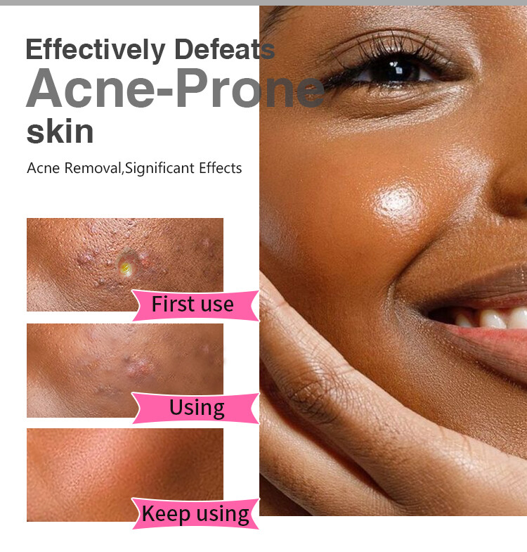 Rapid Clear Stubborn Acne Spots Cream Pimple Cream Face and Body ...