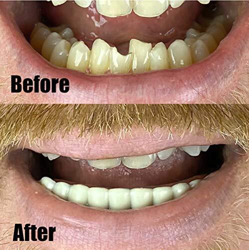 Instant Smile Teeth Lower Veneer 658890121970| eBay