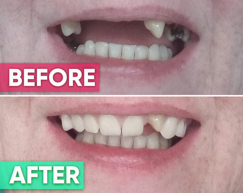 Premium DIY Denture Kit with Impression | Full Partial Flipper Upper ...