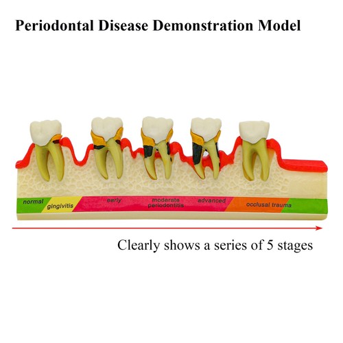 Dental Periodontal Disease Demo Model PER Progressive Disease Display 5 ...