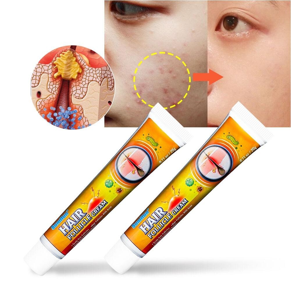 Hair Follicle Cream Treat Folliculitis Skin Inflammation Antibacterial ...