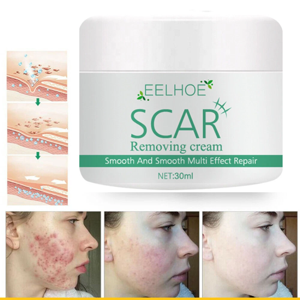 Acne Scars Removal Cream