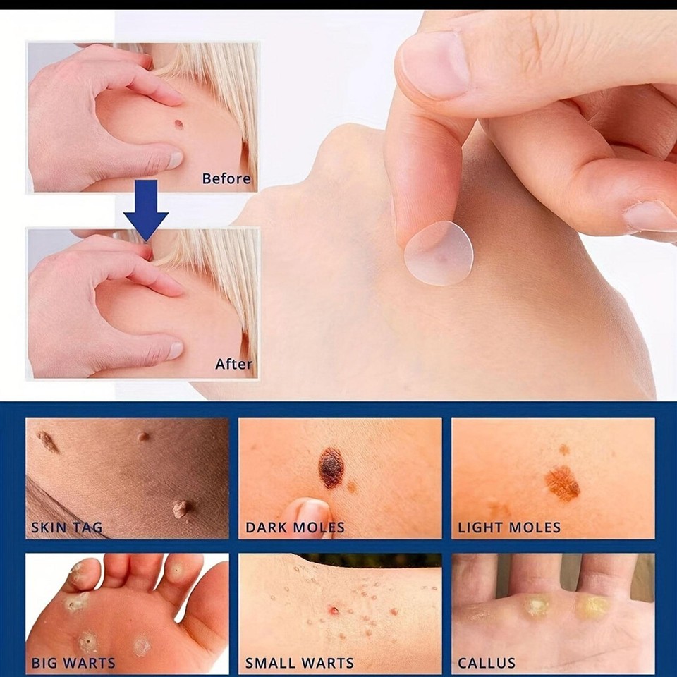 144pcs Skin Tag Remover Patches Quick Effective Mole Wart Removal Pad ...