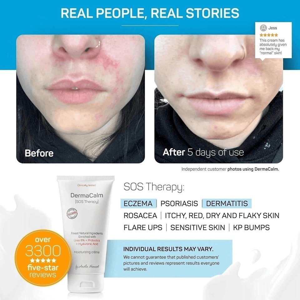 1X Clinically Tested DermaCalm SOS Therapy - Eczema Psoriasis ...