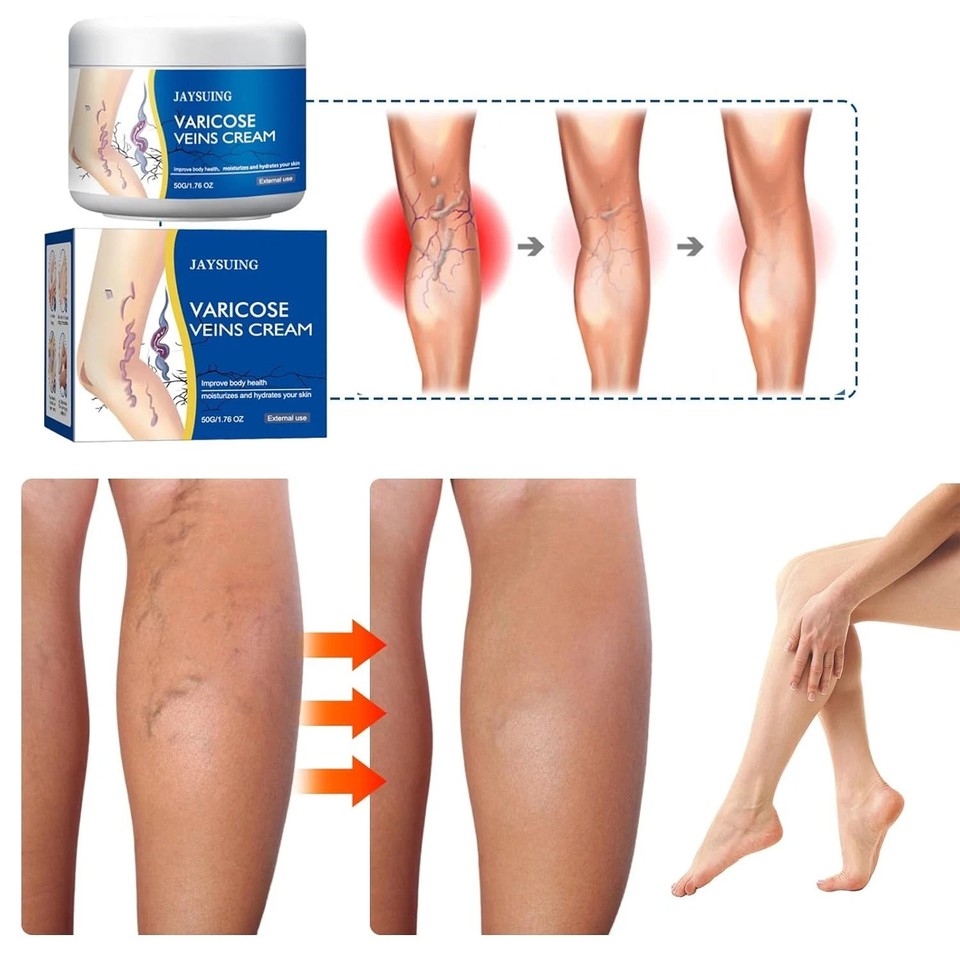 (5-Pack) Varicose Veins Cream for Legs 1.76 oz. Spider Veins Relief Exp ...