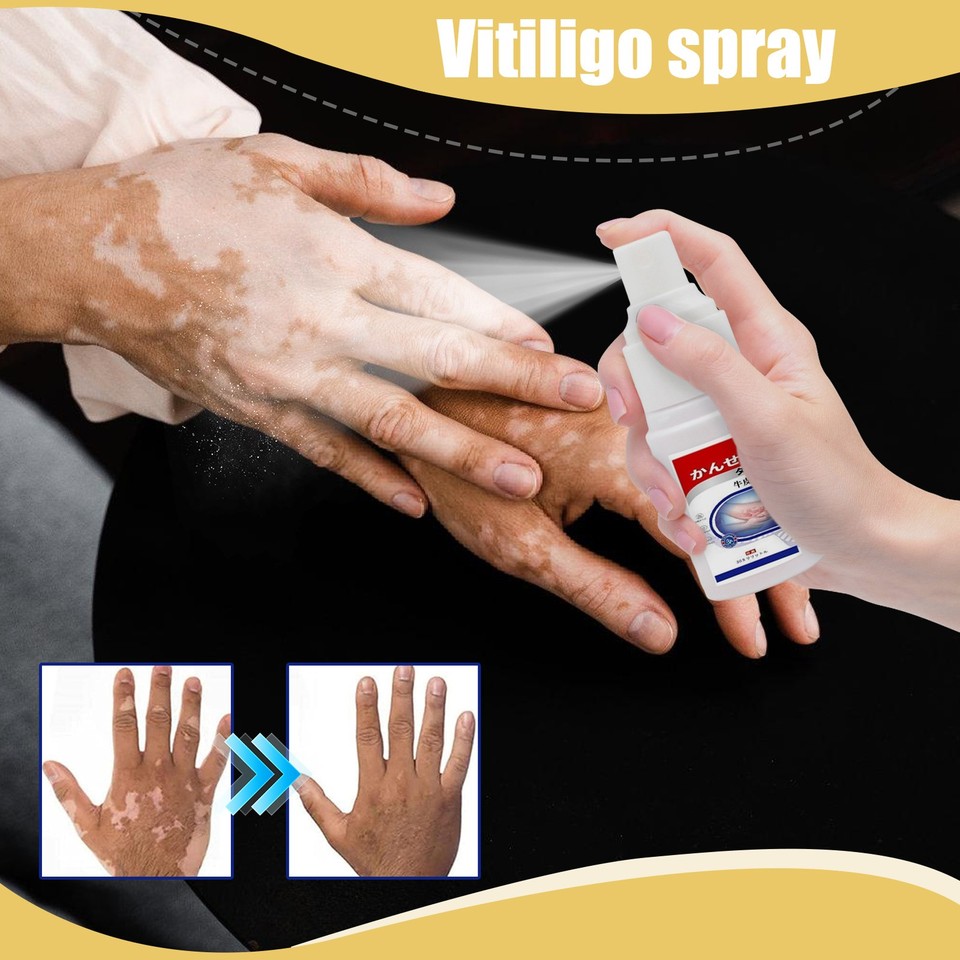 Timilk Viticlear Vitiligo Spray, Vitiligo Treatment, Vitiligo Treatment ...