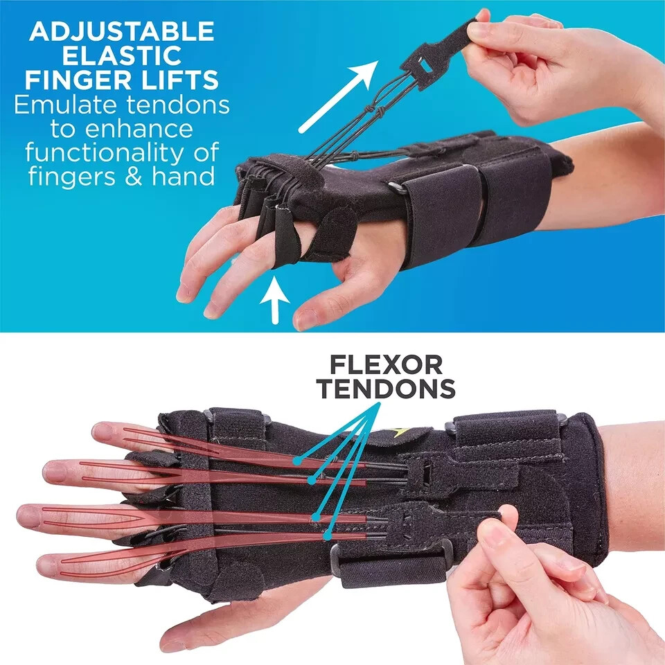 Radial Nerve Palsy Splint - Dynamic Wrist Drop Splint for Limp Finger ...