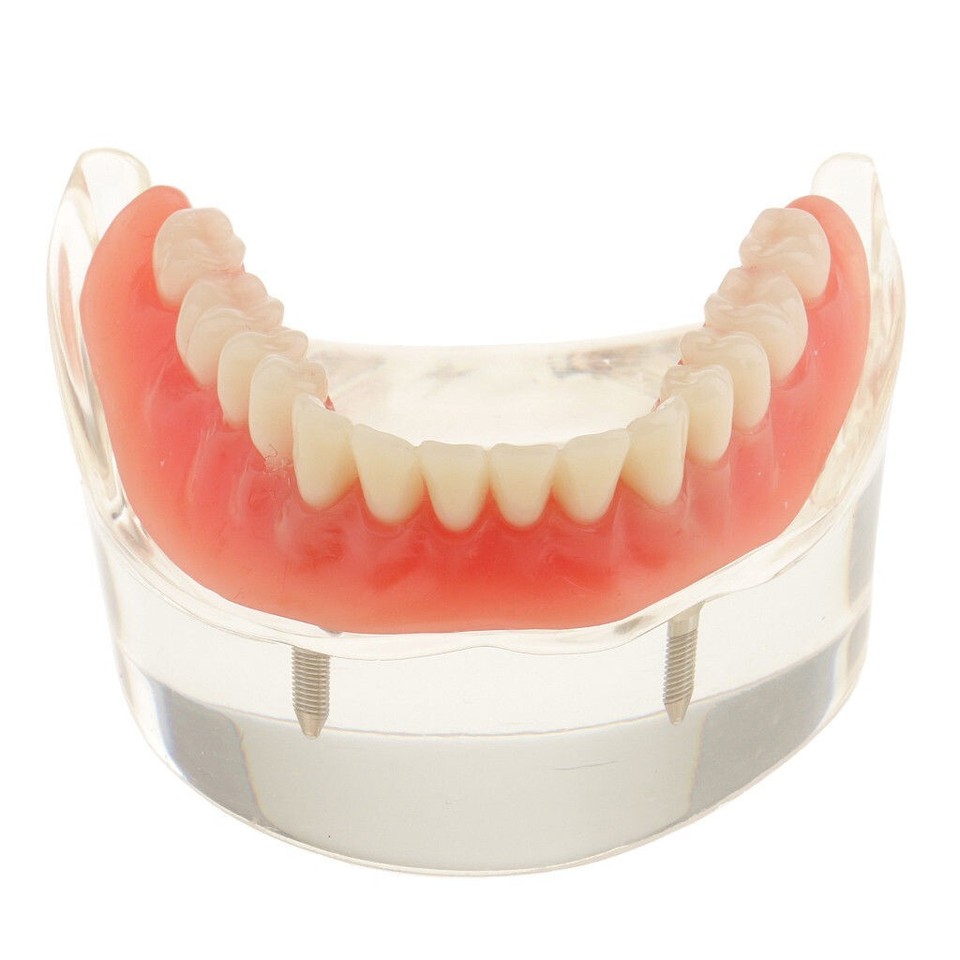 Dental Implant Teeth Model Mandibular Overdenture Restoration 2 Lower ...
