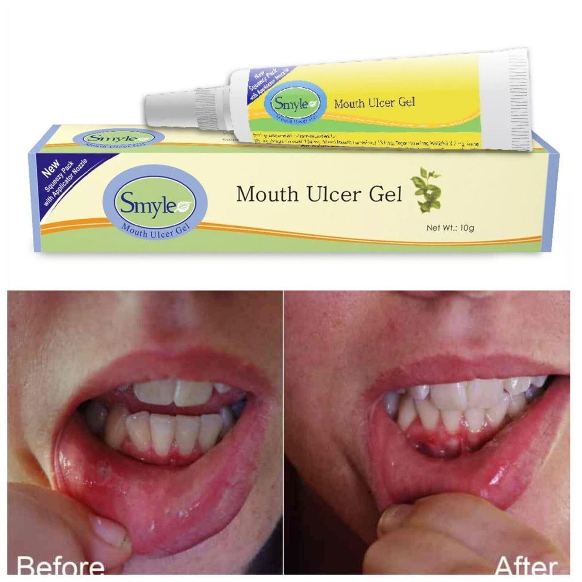 Tongue Ulcer Gel
