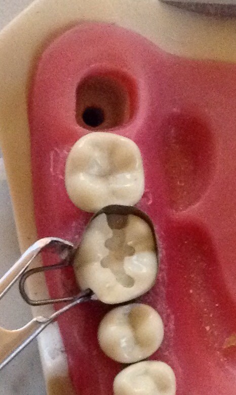 Dental Matrix Bands / The U Dental Bands. MOD Kit. | eBay