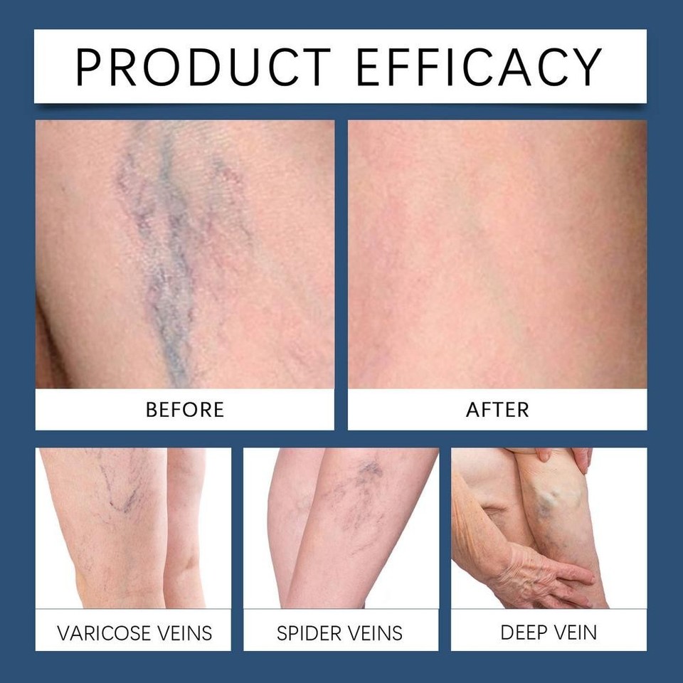 Vein Guard Herbal Spray 30ml Non-Irritating Plant Leg Product Personal ...