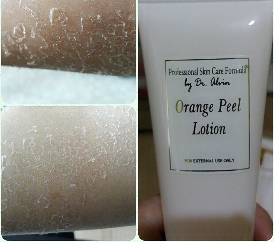 Dr. Alvin PSCF Orange Peel Lotion Orange Peel Soap Whitening Remove ...