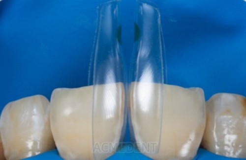 Clear Matrix Dental Anterior Matrices Posterior Class II Fit BioClear ...