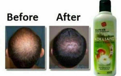 Kok Liang Shampoo KOK LIANG ANTI DANDRUFF HAIR LOSS SCALP SOOTHES ...