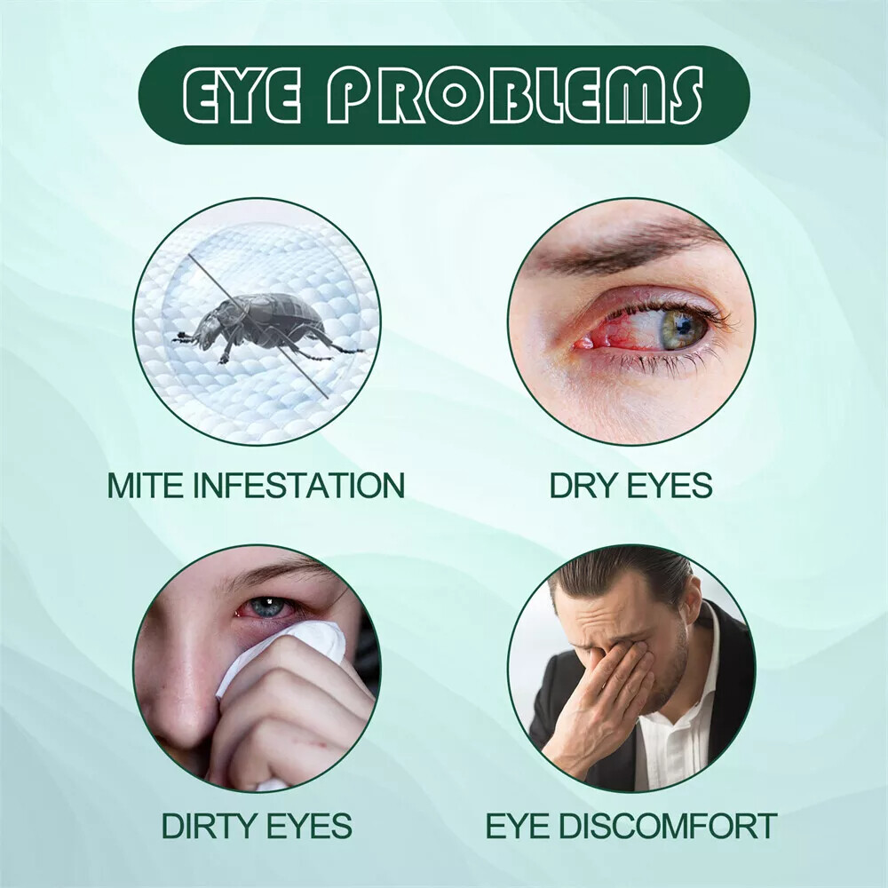 Eye Mite Removal Wet Wipes Tea Tree Oil Sensitive Dry Eyes Blepharitis ...