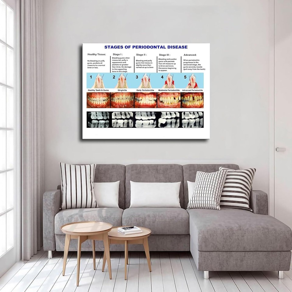 Dental Clinic Wall Poster Periodontal Disease Staging Chart Painting ...
