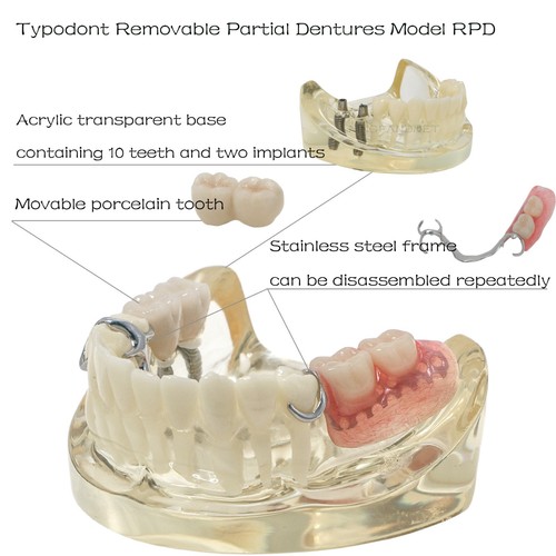 Dental Implant RPD Restoration Model Removable Partial Denture Lower 2 ...