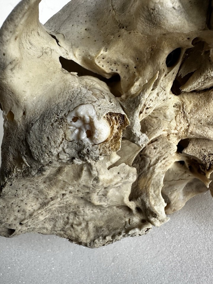 Authentic Human Skull-no Mandible-impacted Molar Was Cause Of Death ...