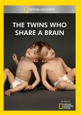 THE TWINS WHO SHARE A BRAIN 727994952794| eBay