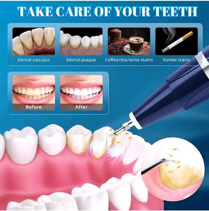 Ultrasonic Teeth Cleaning Kit Plaque Remover Teeth Dental Cleaner ...
