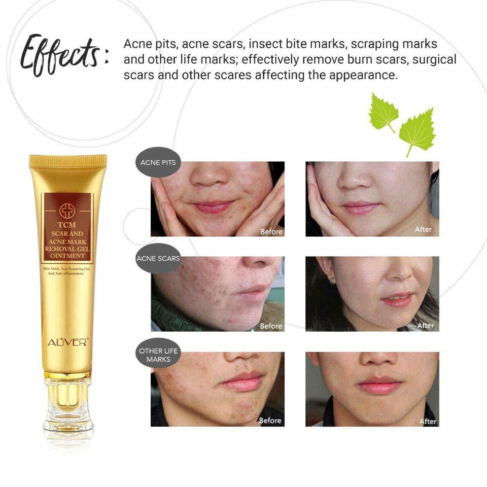 ALIVER TCM SCAR AND ACNE MARK REMOVAL GEL OINTMENT Acne Scar Burns ...