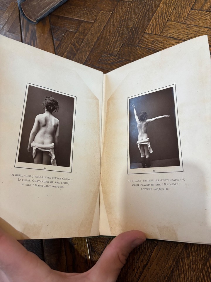 Bernard Roth - The Treatment of Lateral Curvature of the Spine ...