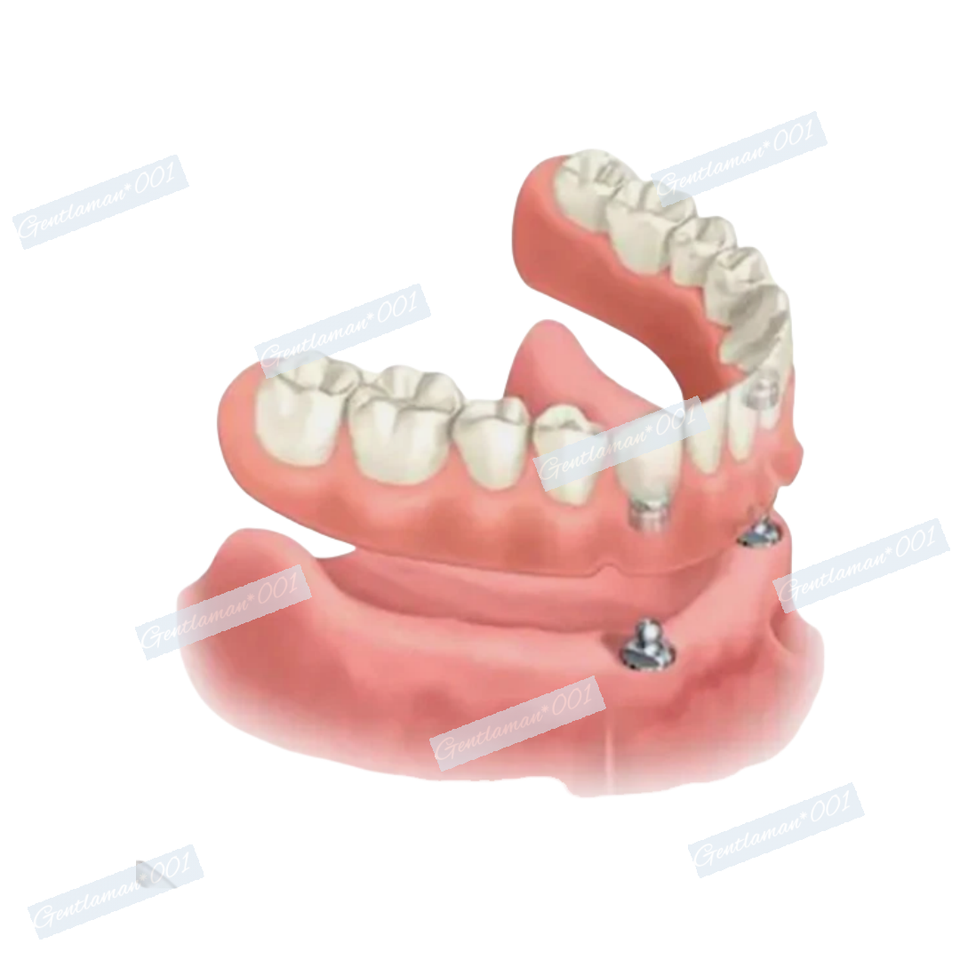 Dental O-Ring Kit Overdenture Retention Ball Abutment Fits Osstem Metal ...