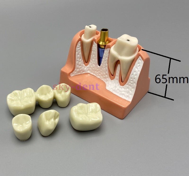 Dental Typodont Teeth Model Ortho Implant Pathological Perio Practice ...