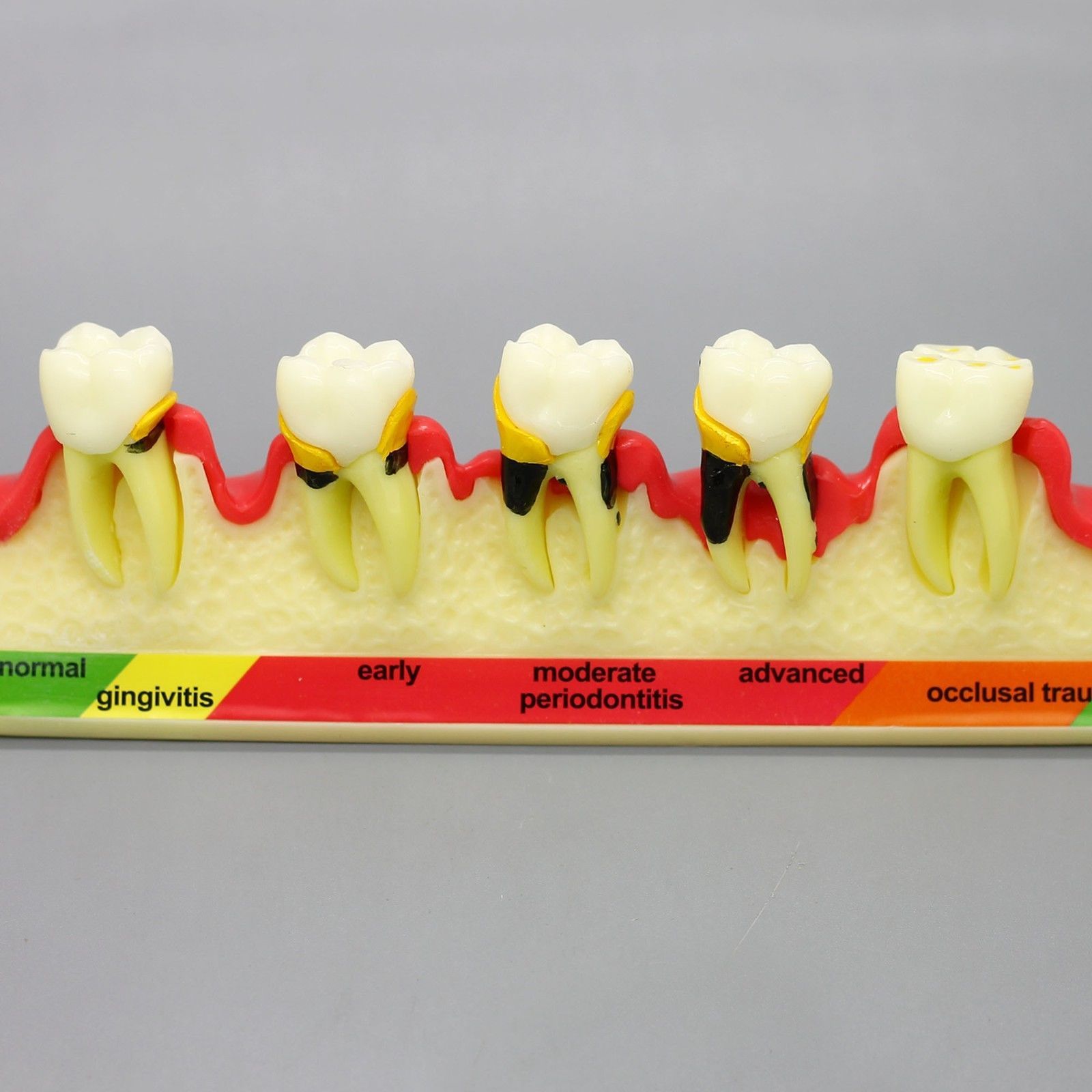Dental 5-Stage Periodontal Teeth Disease Dentoform Typodont Assort ...
