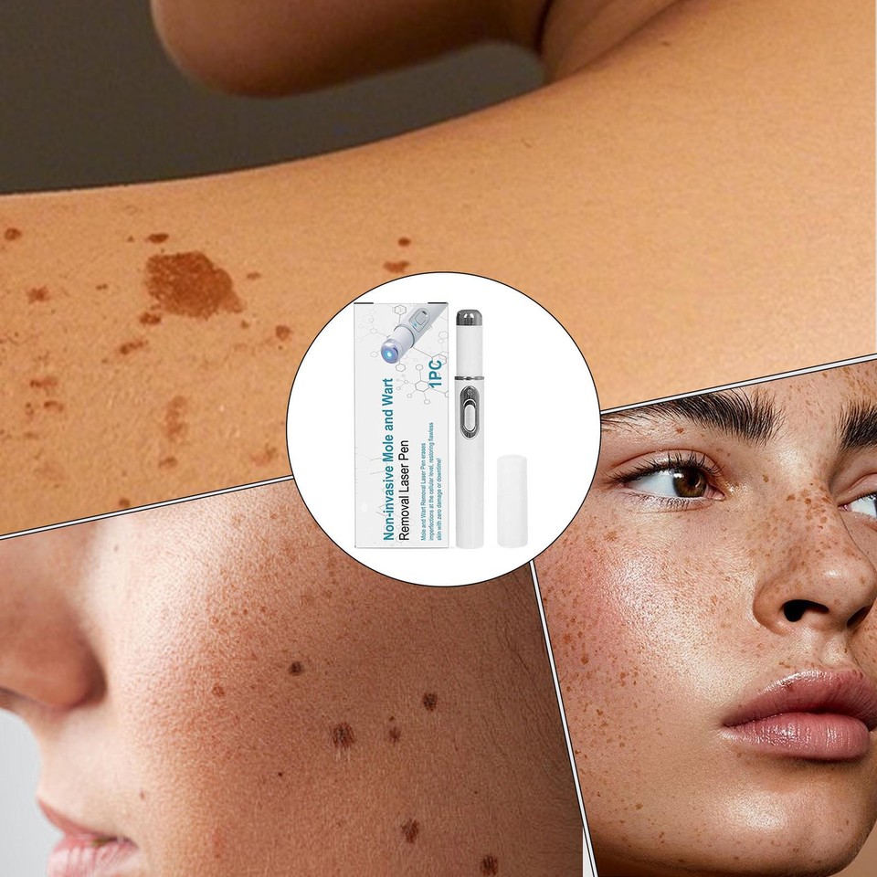 Non-Invasive Mole and Wart Removal Laser Pen, Advanced Skin Tag Removal ...