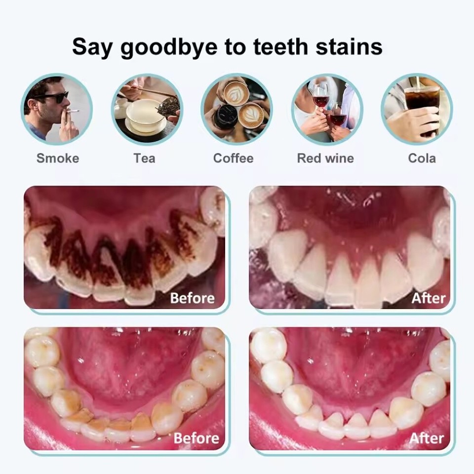 Electric Tooth Cleaner Ultrasonic Dental Scaler Tartar Plaque Calculus ...