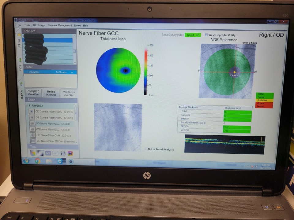 Optovue iVue OCT Optical Coherence Tomographer CAM, table, Windows 7 ...
