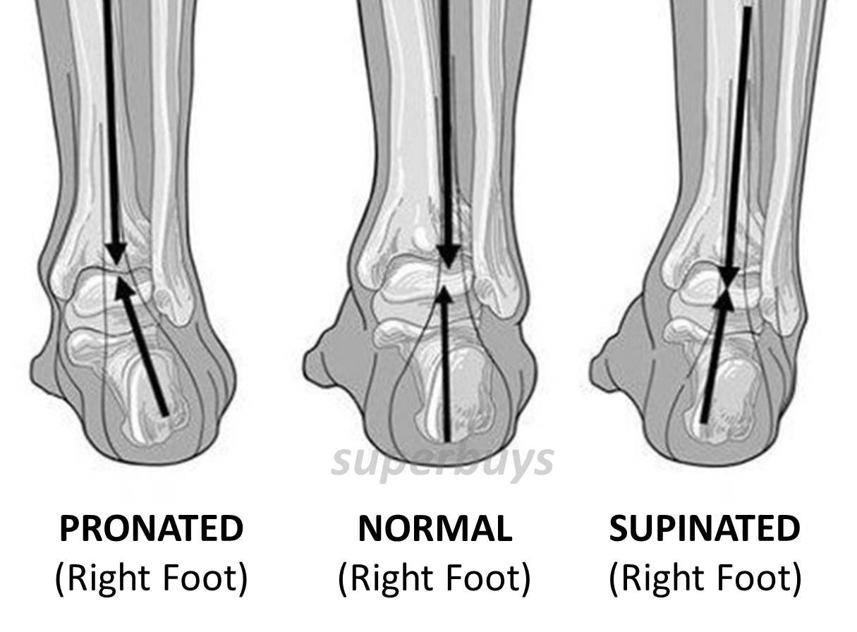Large Inward & Outward Rolling Angled Feet Correcting Foot Heel Cup Gel ...
