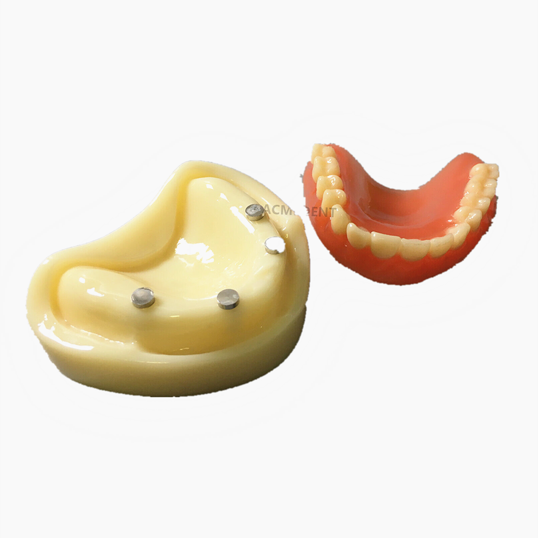 Dental Full Denture Model Overdenture Magnetic Attachment Mandibular ...