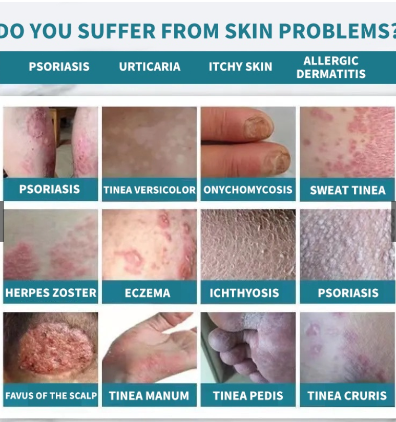 Psoriasis Cream Antifungal cream Eczema cream Cream 20g | eBay