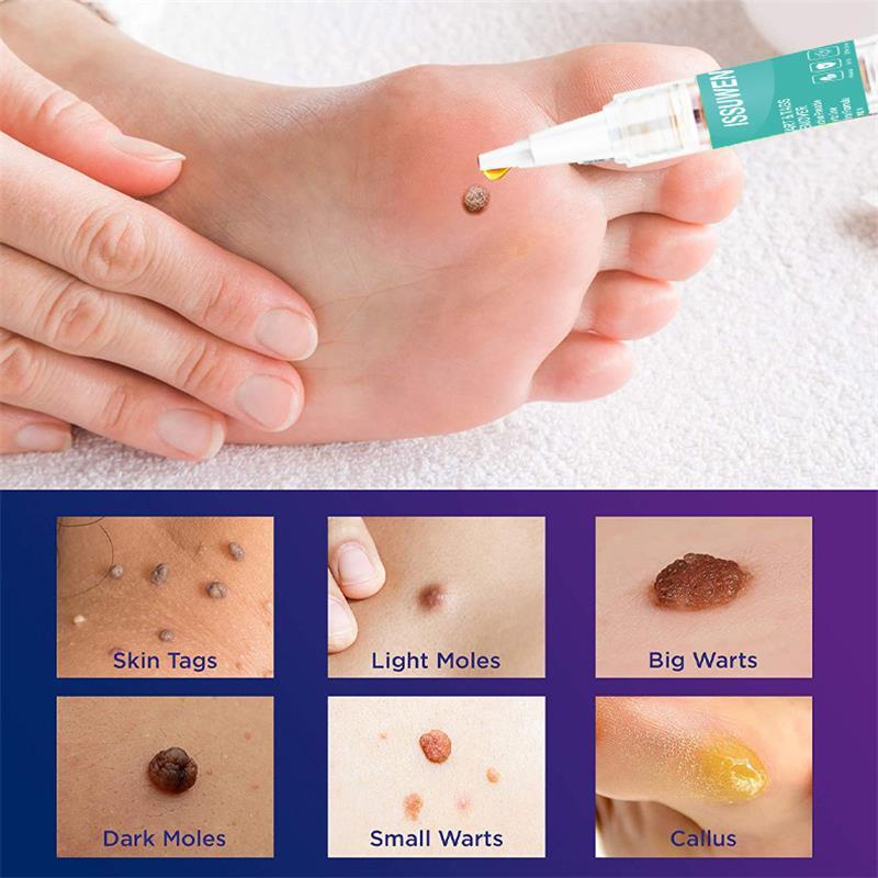 4X Wipe Off Tags & Moles Remover Fast Easy Effective Tags & Moles Fast ...