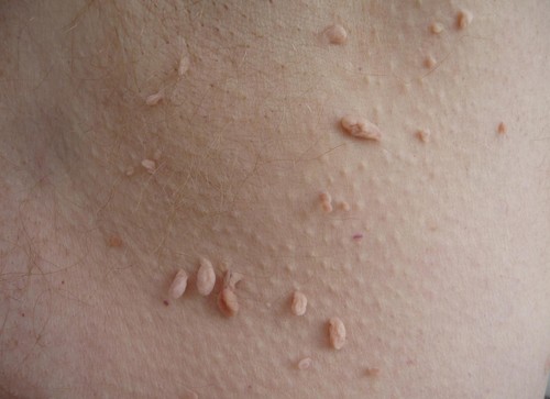 1 Quita Verrugas Natural Homeopathic Sani Skin Tag Remover saniskin ...